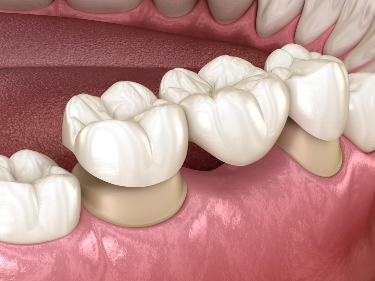 4 Types of Dental Bridges – Sedation Dental Care at Raleigh Smile Center
