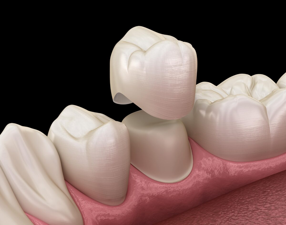 What is a Tooth Cap? – Sedation Dental Care at Raleigh Smile Center