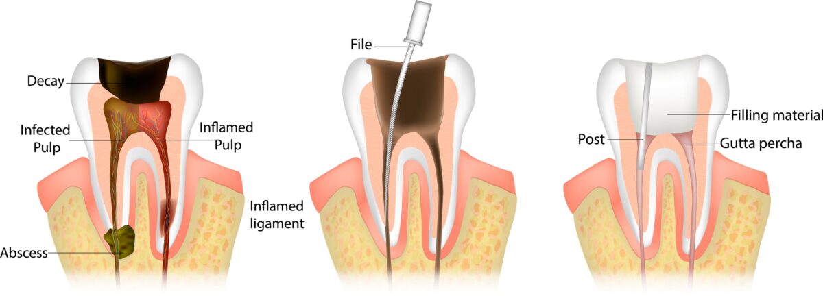 The Top Treatments for Pulpitis – Sedation Dental Care at Raleigh Smile ...